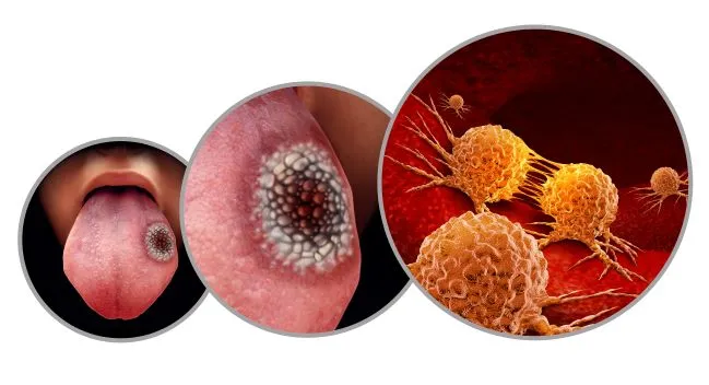 Oral Cancer Screenings Hudson, WI | Oral Pathology Woodbury, MN