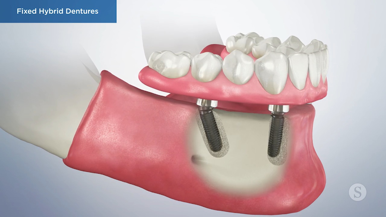Implant-Supported Bridges & Dentures | Hudson & Woodbury