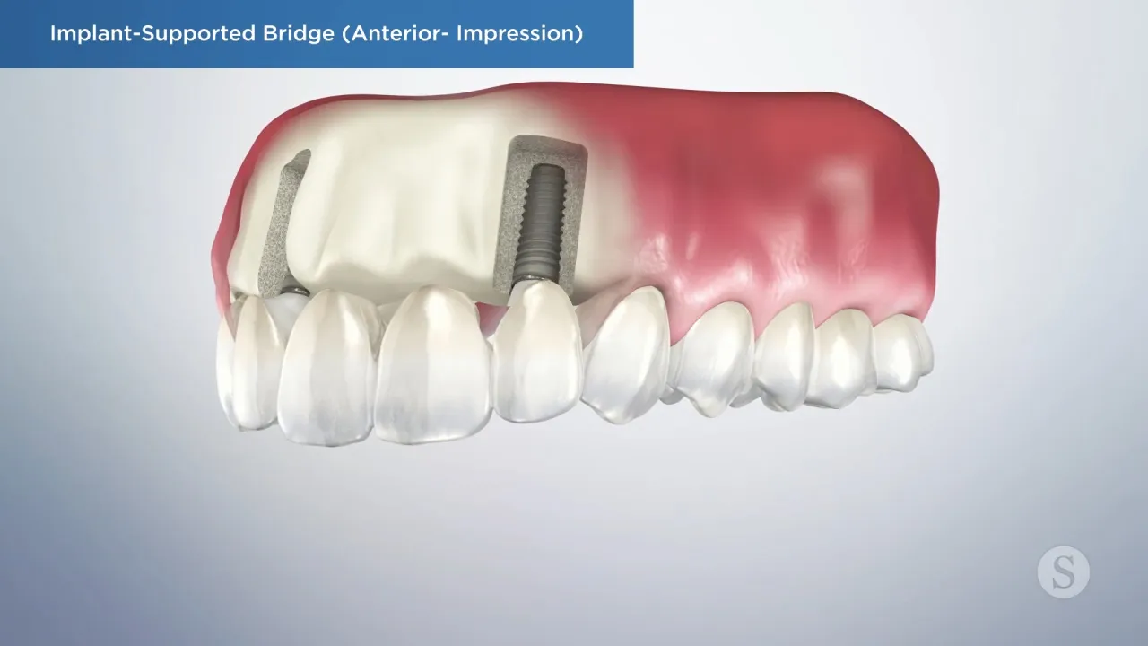 Implant-Supported Bridges & Dentures | Hudson & Woodbury