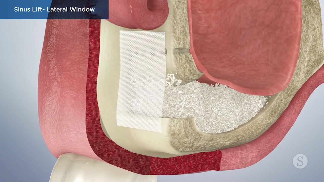 Sinus Lift Augmentation for Implants | Hudson & Woodbury